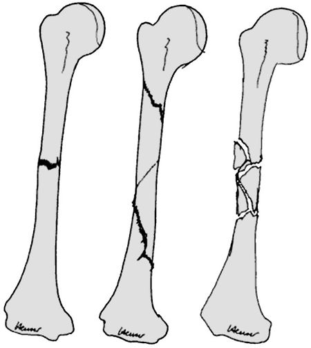 Brudd, brist eller kompresjon i ryggen - Helseleksikon.no
